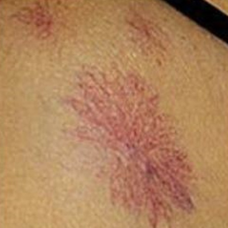 Alpha-1-Antitrypsinmangel - wie stark ist meine Leber?